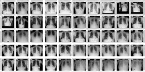NIH Chest X-ray Dataset - Machine Learning Datasets